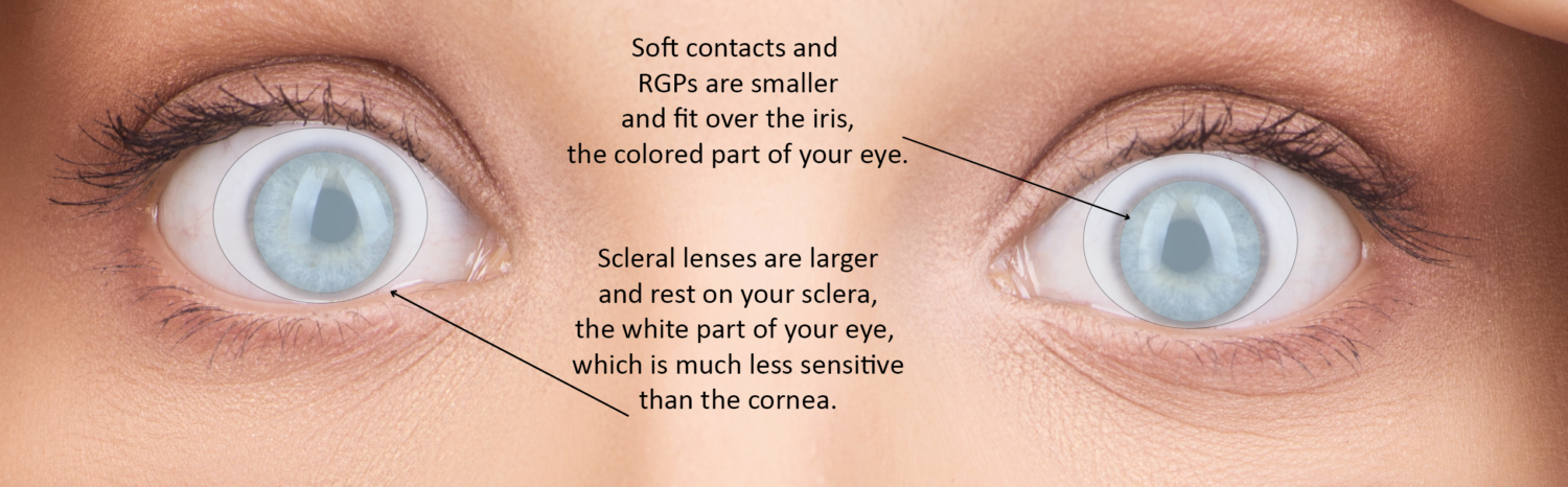Scleral Contacts | Scleral Lens Basics for Patients | BostonSight SCLERAL